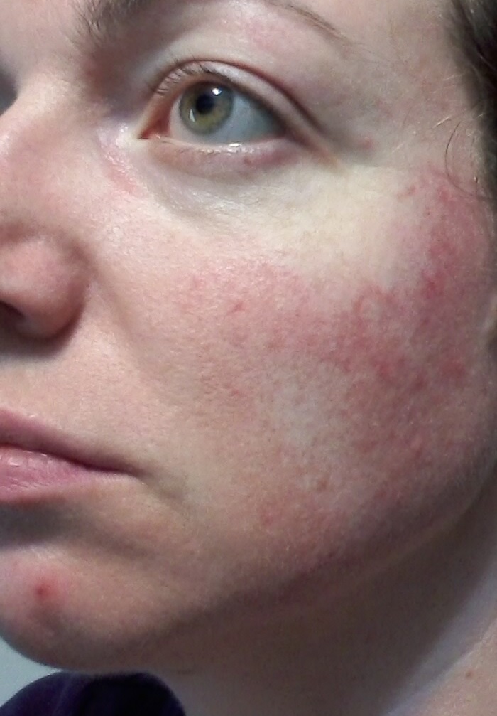 Day 1 – LED Red Light Therapy for Rosacea – Living the "Rosy Life"