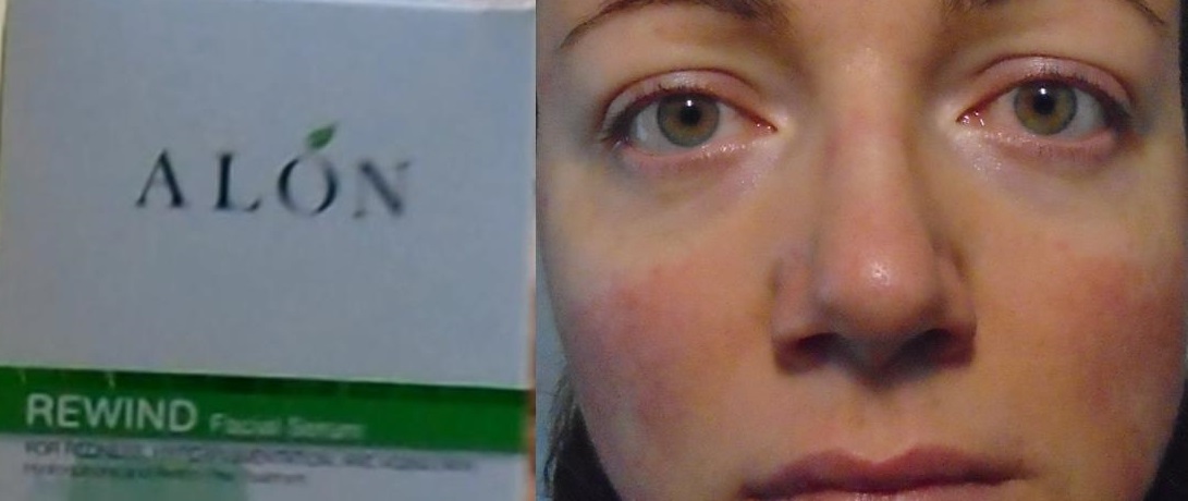 Product Review: Alon Labs Rewind Facial Serum for Redness & Rosacea ...