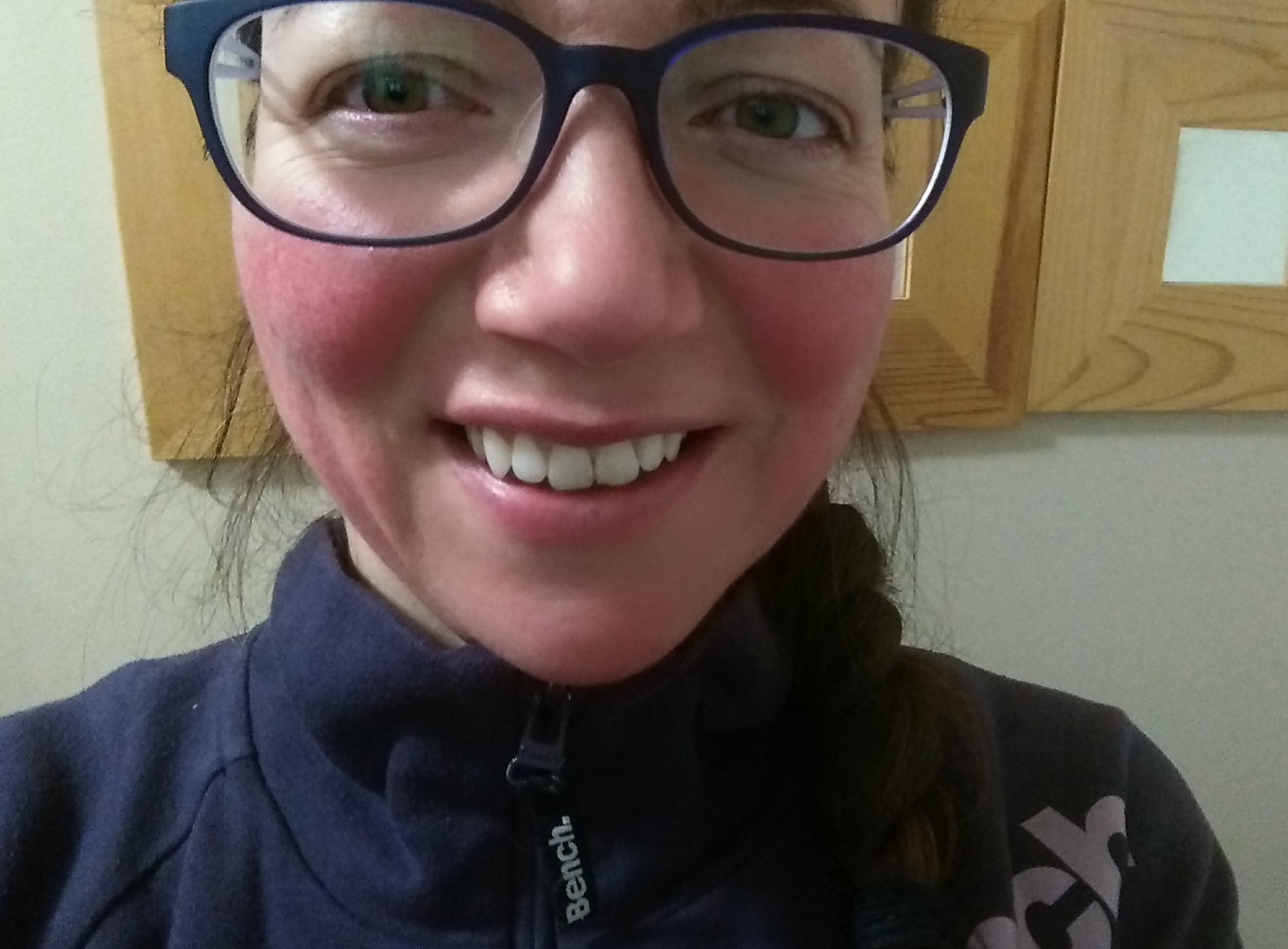 I’ve Stopped Covering My Rosacea With Makeup – Living the "Rosy Life"